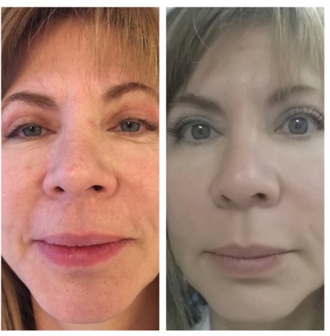 Sava Stem Cell Facelift Technique - Victor Regenerative Medicine Centers