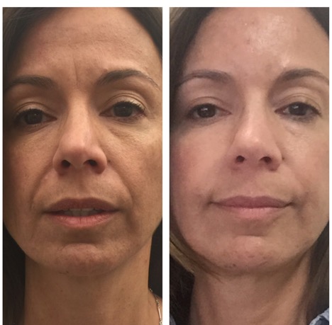 Sava Stem Cell Facelift Technique - Victor Regenerative Medicine Centers